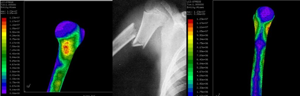 Humerus analysis, anisotropic material on CalculiX – Home | Libre Mechanics